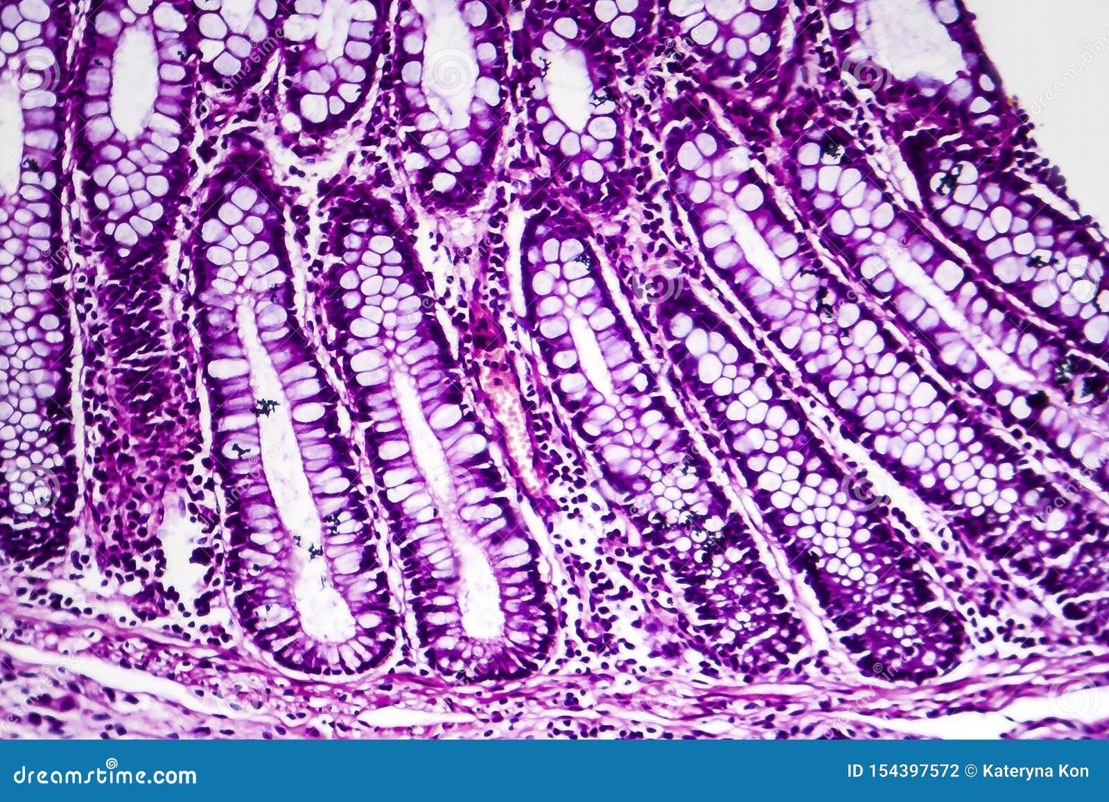 Bacillary Dysentery, Light Micrograph Stock Photo - Image of histology ...