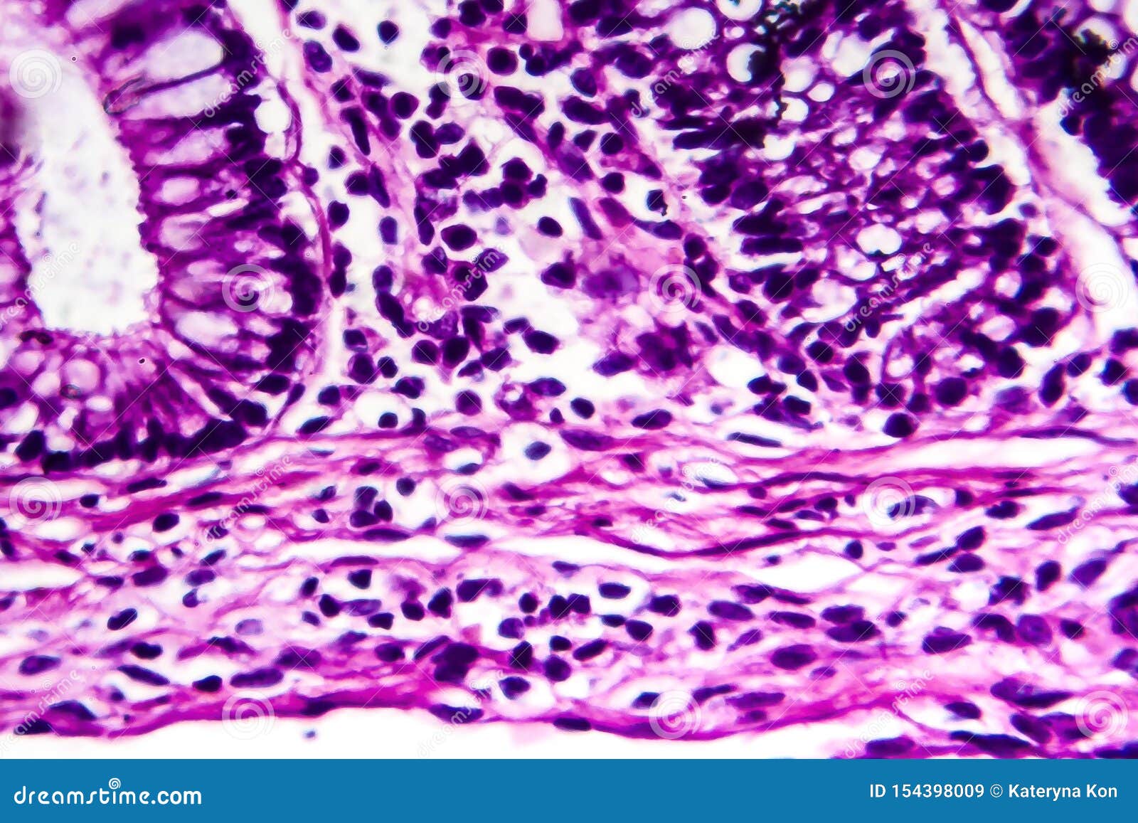 Bacillary Dysentery, Light Micrograph Stock Image - Image of bacillary ...