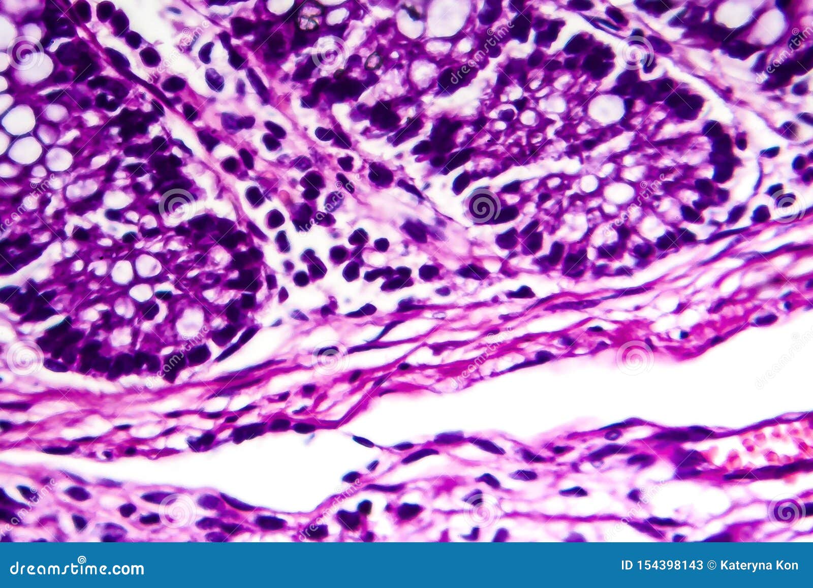Bacillary Dysentery, Light Micrograph Stock Image - Image of ...