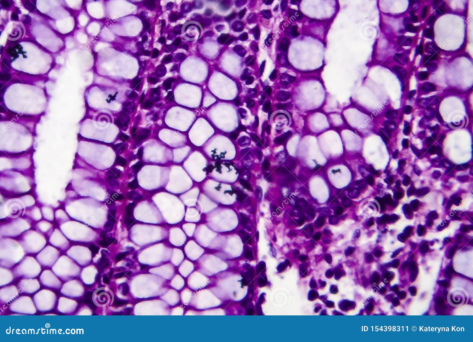 Bacillary Dysentery, Light Micrograph Stock Image - Image of micrograph ...