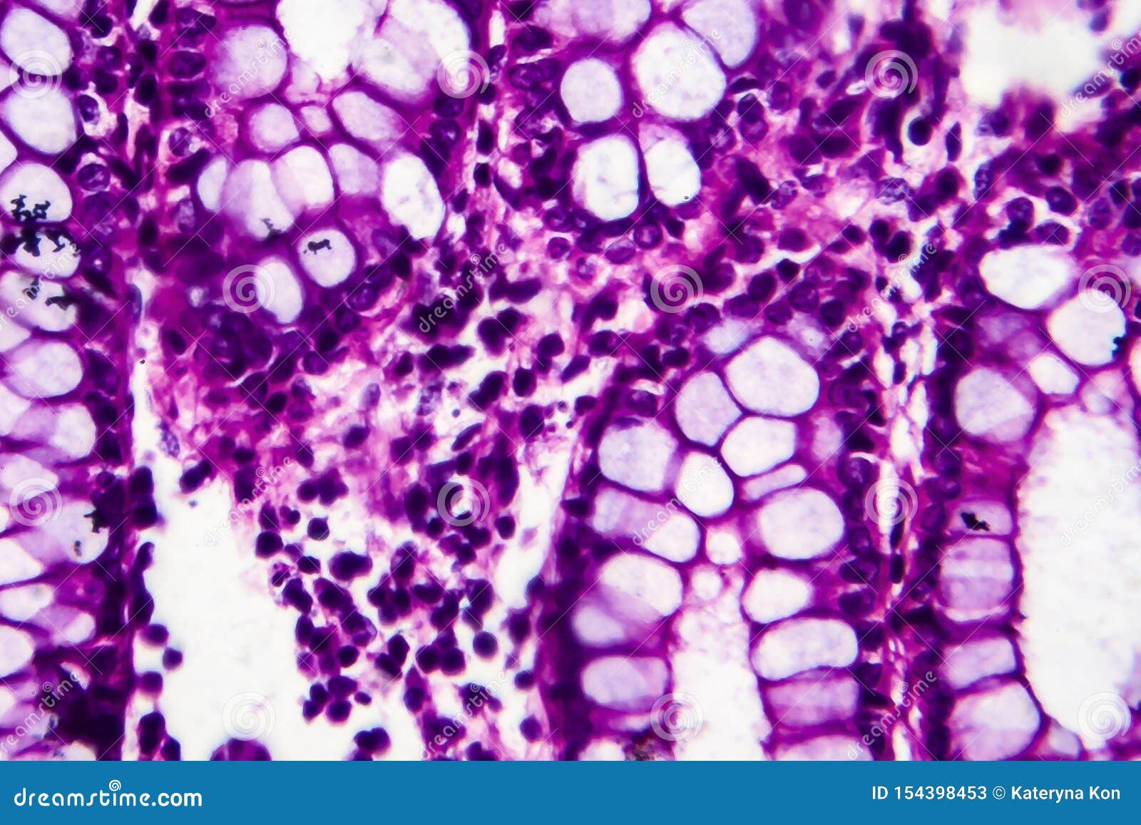 Bacillary Dysentery, Light Micrograph Stock Image - Image of ...