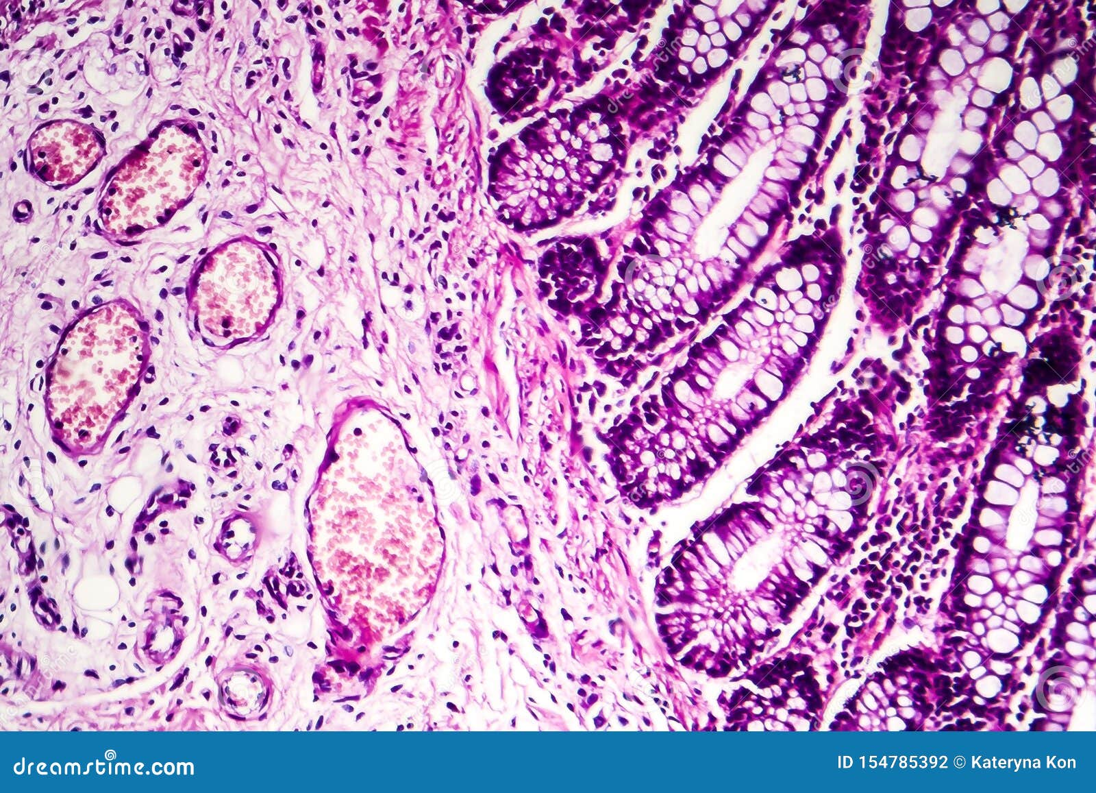 Bacillary Dysentery, Light Micrograph Stock Photo - Image of hemorrhage ...