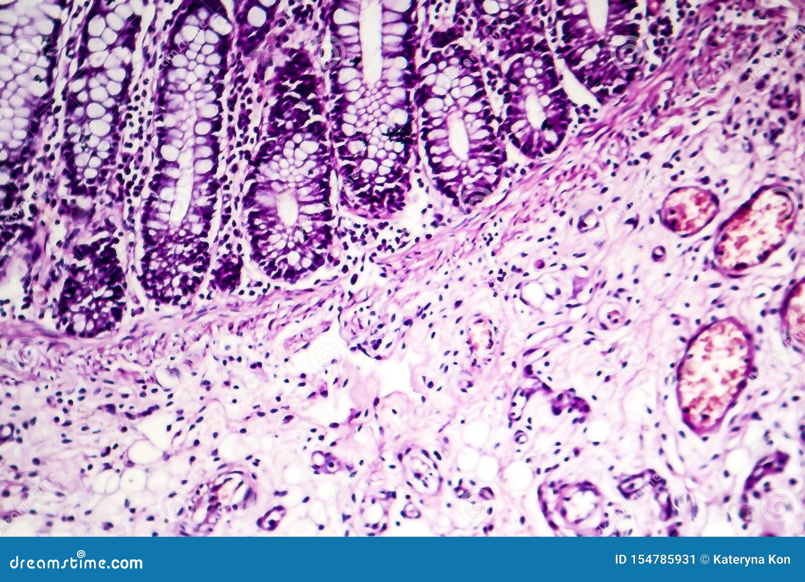 Bacillary Dysentery, Light Micrograph Stock Image - Image of ...