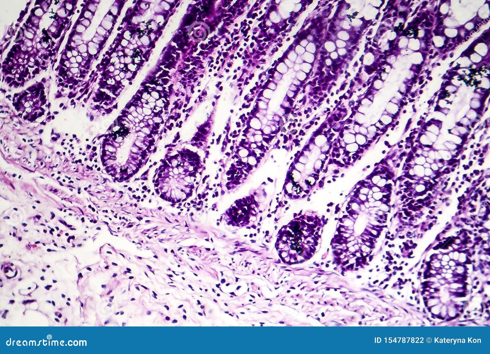 Dysentery Stock Images - Download 485 Royalty Free Photos