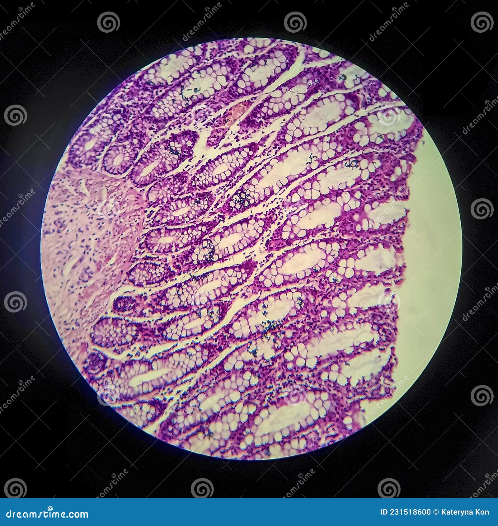 Bacillary Dysentery, Light Micrograph Stock Photo - Image of medicine ...