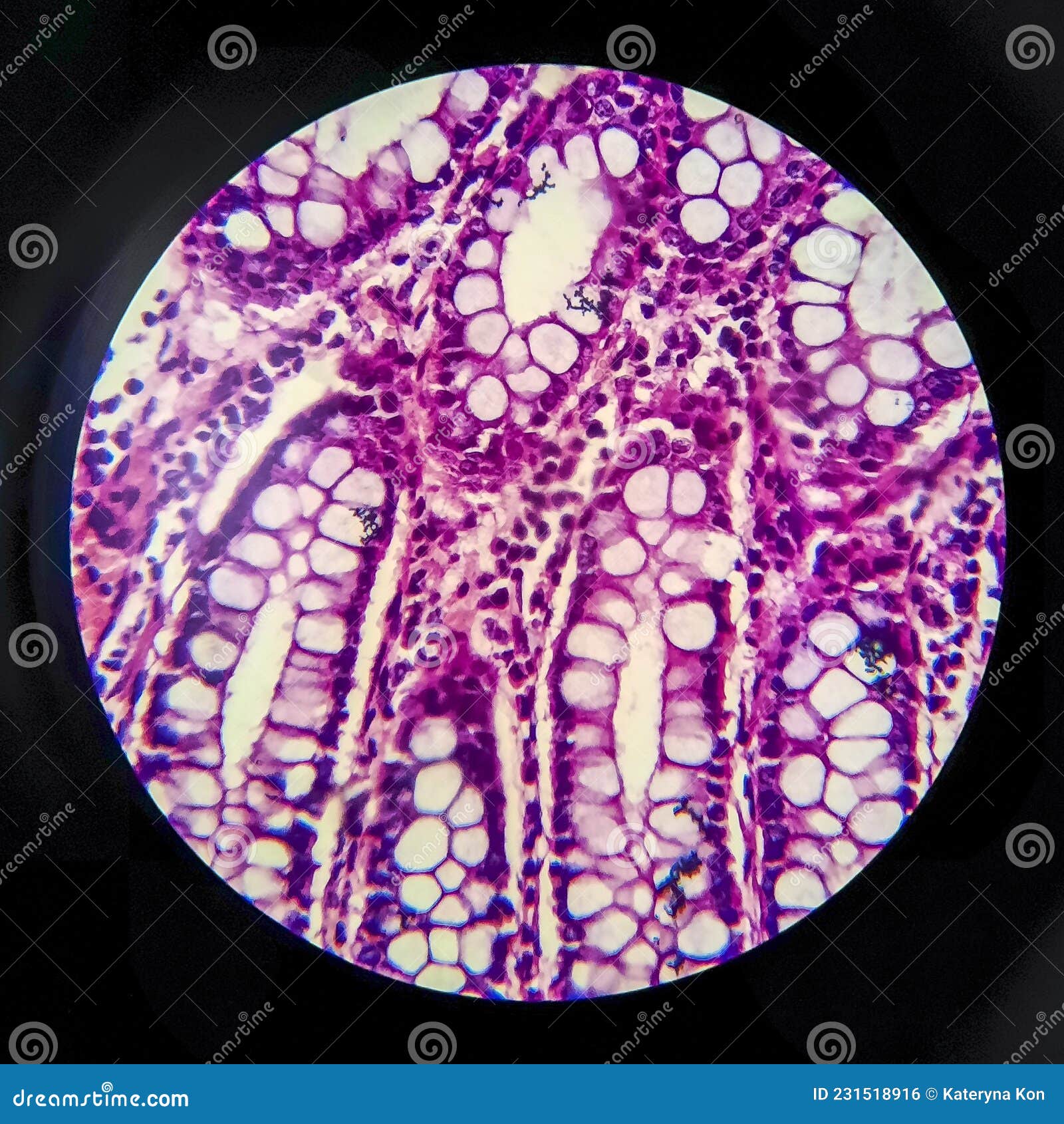 Bacillary Dysentery, Light Micrograph Stock Photo - Image of bacterium ...