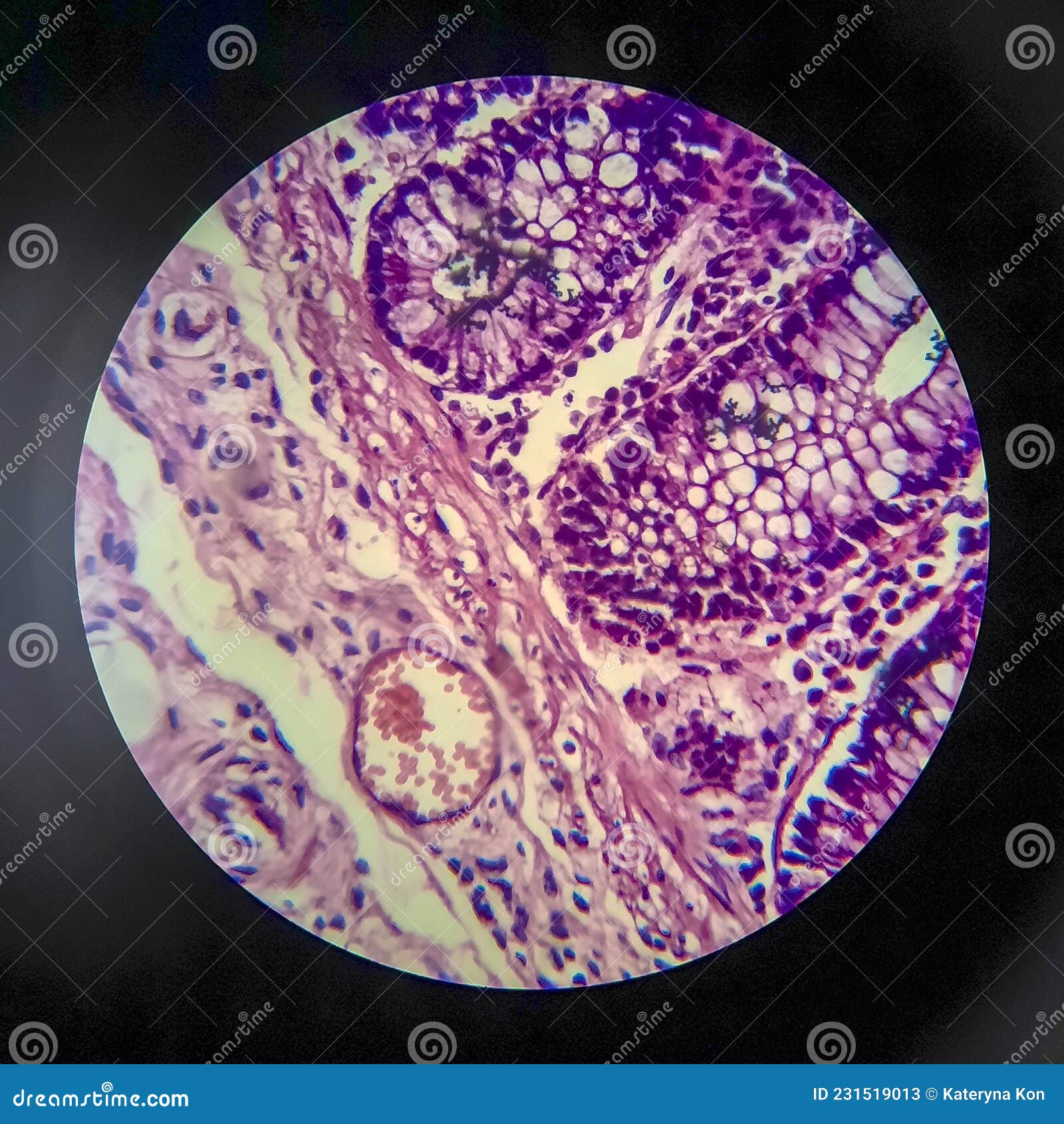 Bacillary Dysentery, Light Micrograph Stock Image - Image of microscope ...