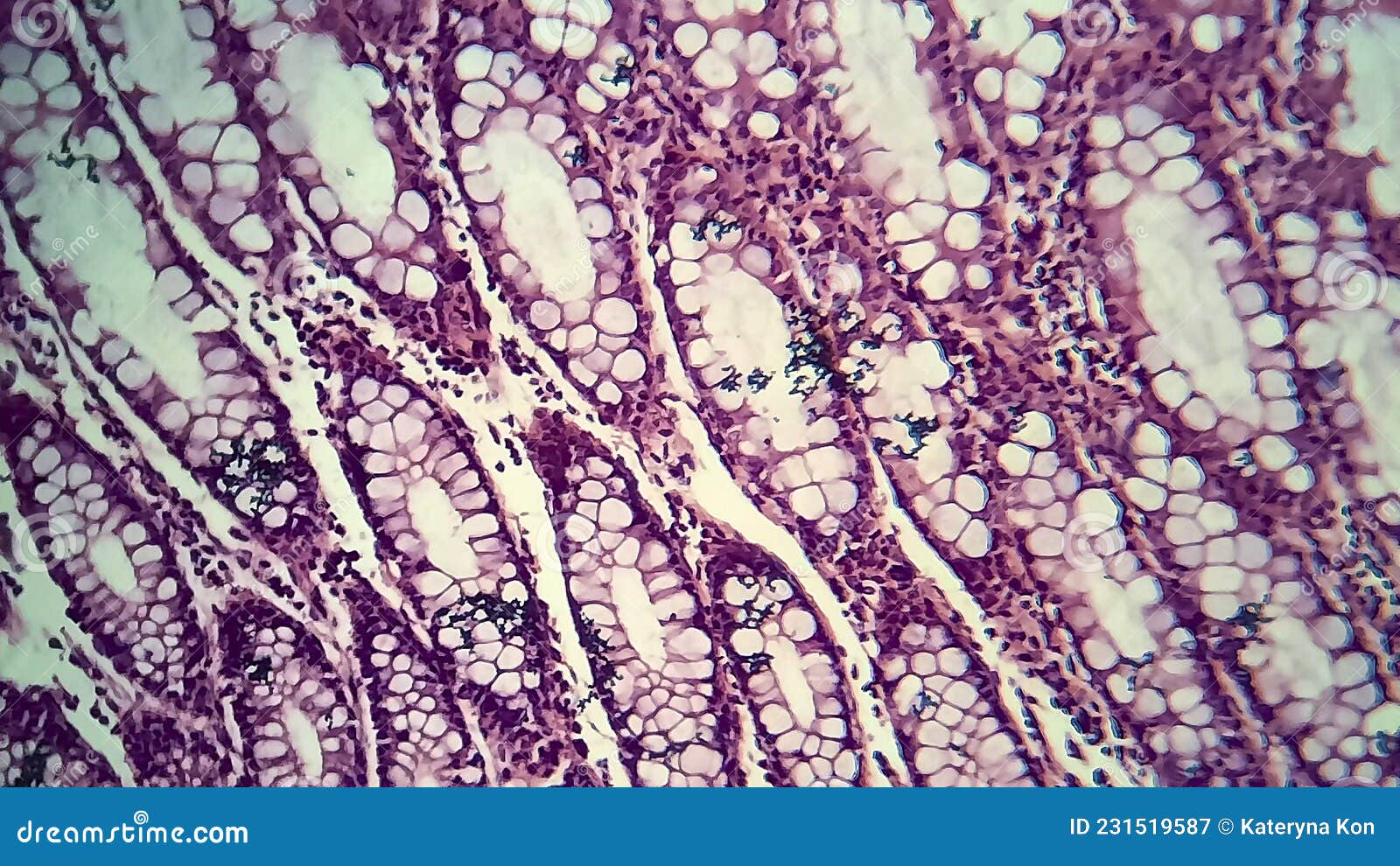 Bacillary Dysentery, Light Micrograph Stock Image - Image of dysentery ...