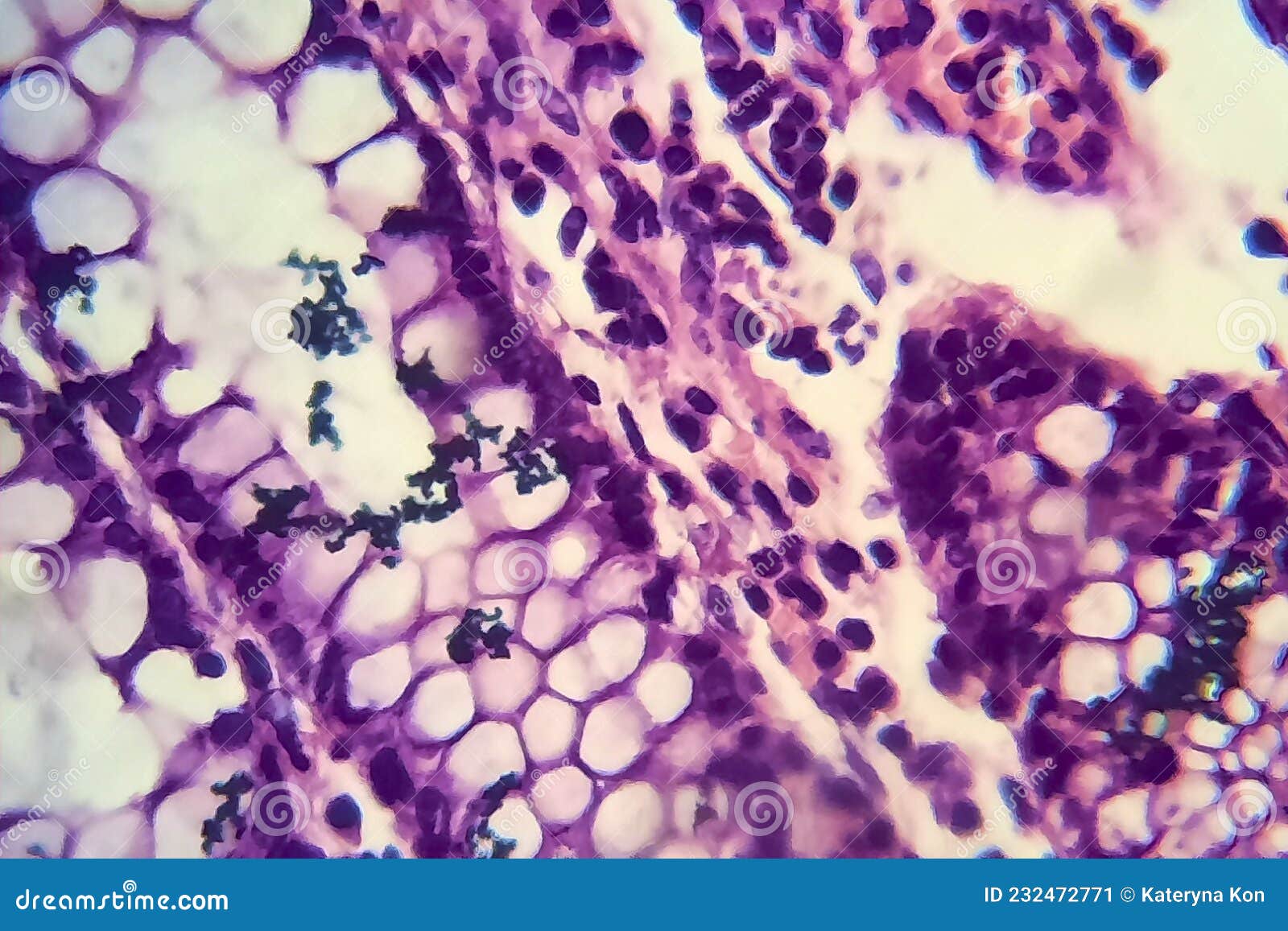 Bacillary Dysentery, Light Micrograph Stock Image - Image of ...