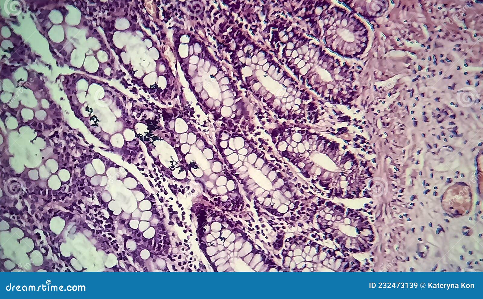 Bacillary Dysentery, Light Micrograph Stock Image - Image of tissue ...