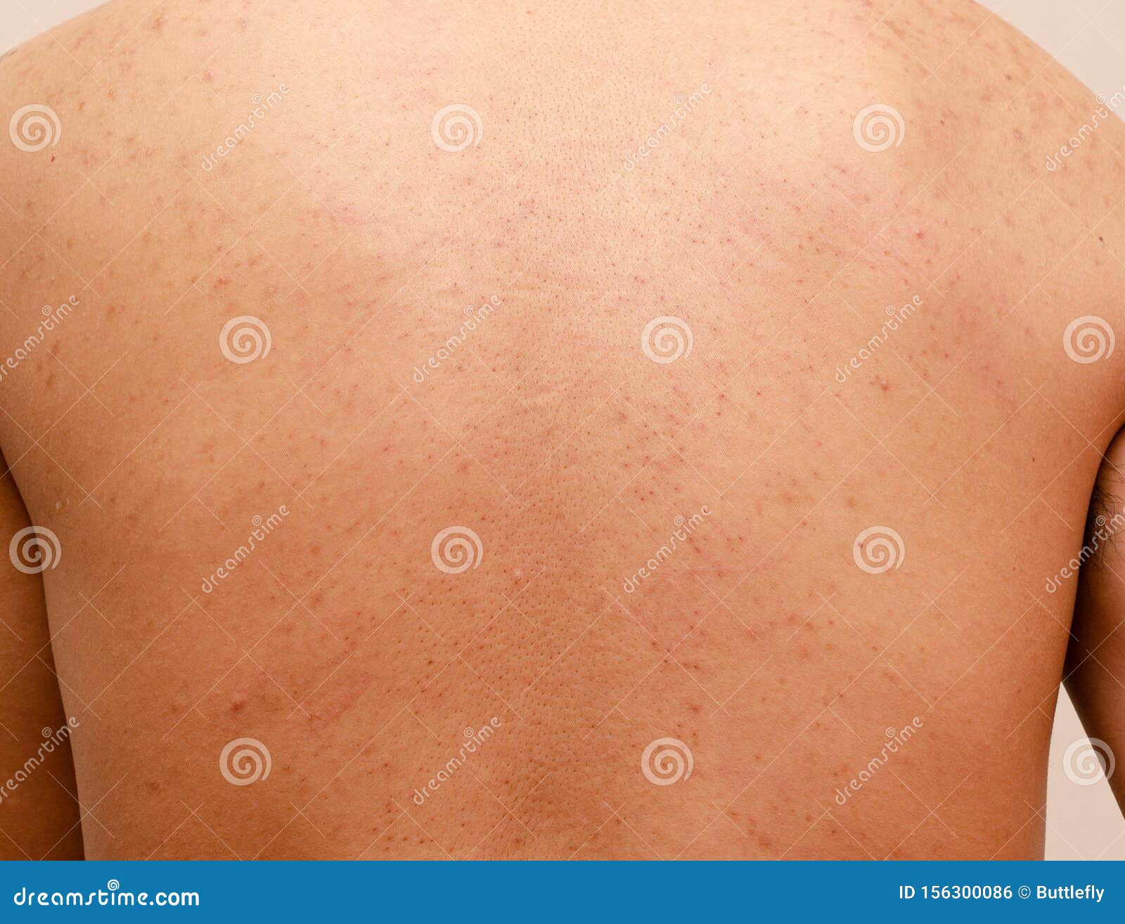 The Back of an Asian Man with Acne Stock Photo - Image of white ...