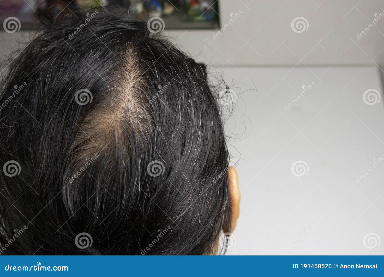 The Back of the Bald Man Caused by Hair Loss Stock Photo - Image of ...