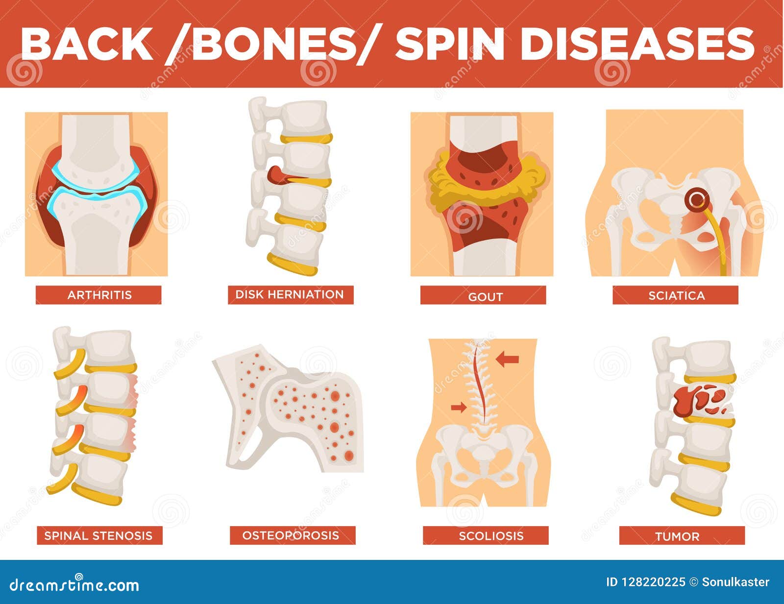 Spinal Osteoporosis. Vertebral Lesion Anatomical Poster. Disease Of ...