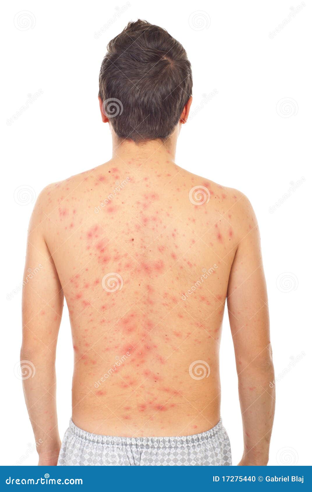 Diagnosis Chickenpox Photos - Free & Royalty-Free Stock Photos from ...