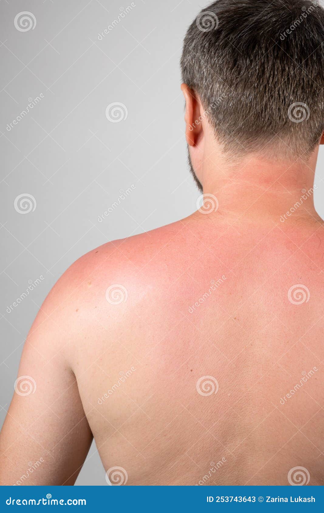Back of a Man with a Sunburn, Close-up. Stock Image - Image of ...