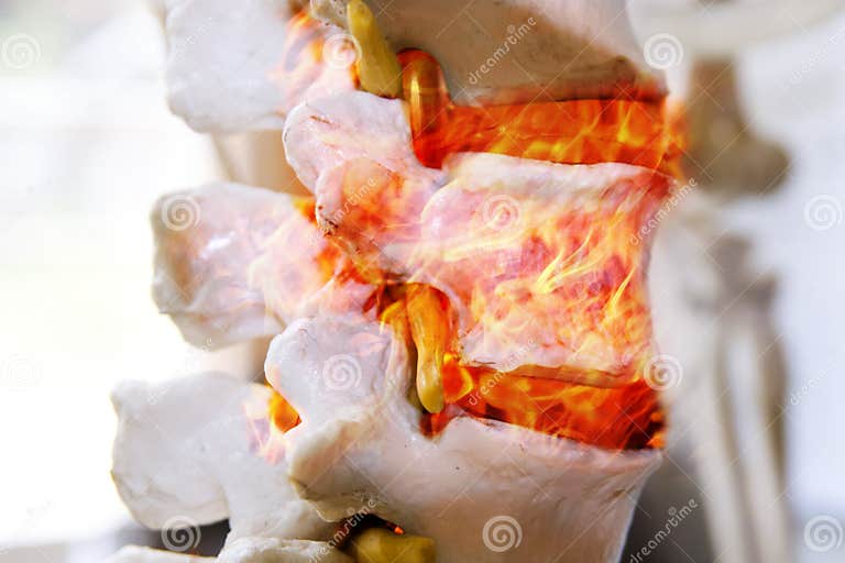 Back Pain. Colorful Anatomy of Spine in Fire Stock Photo - Image of ...