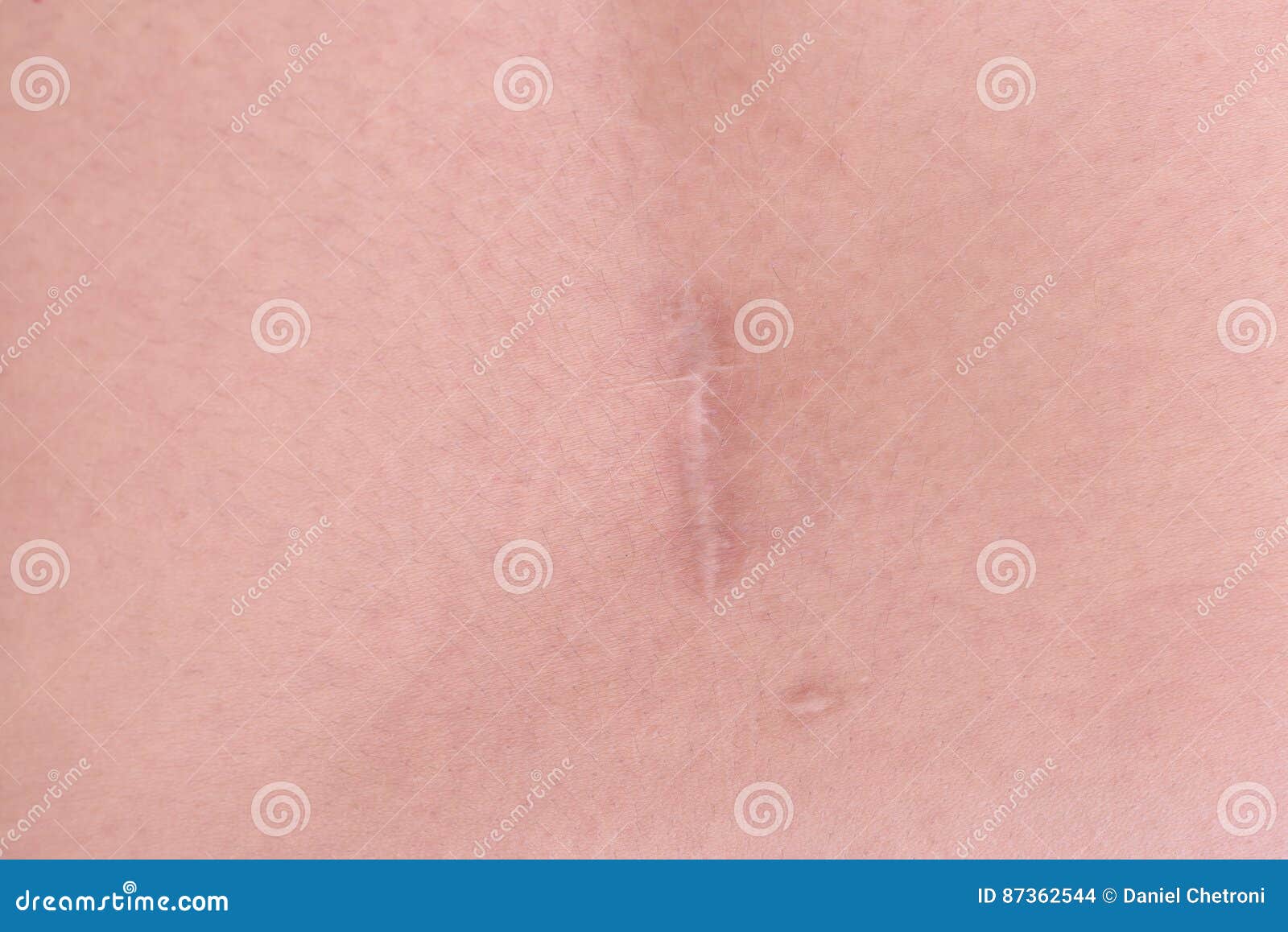 Back Scar Tissue after Herniated Disc Surgery Stock Photo - Image of ...