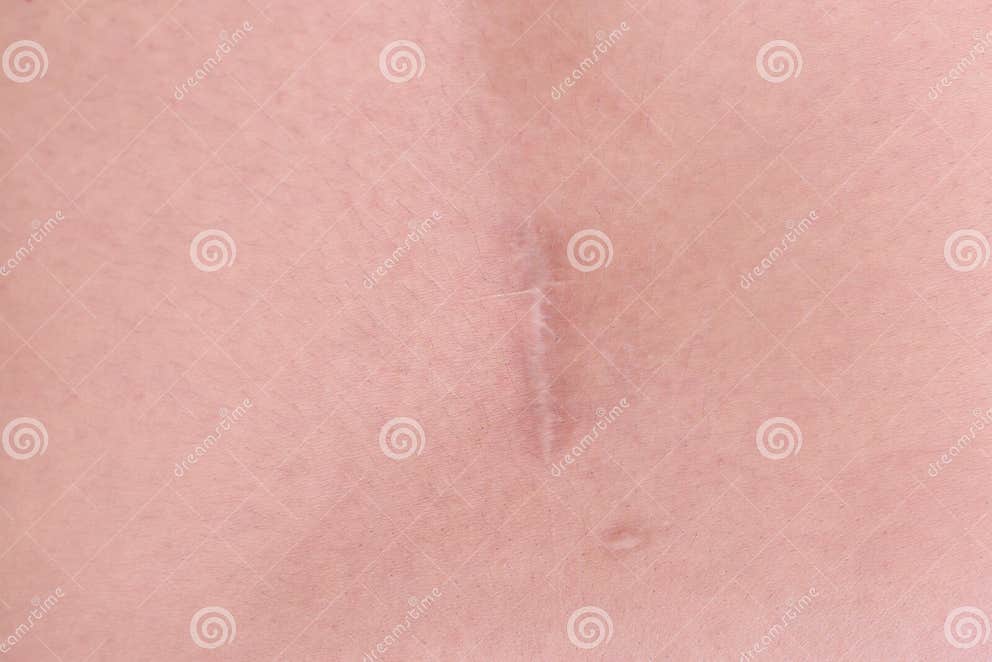 Back Scar Tissue after Herniated Disc Surgery Stock Photo - Image of ...