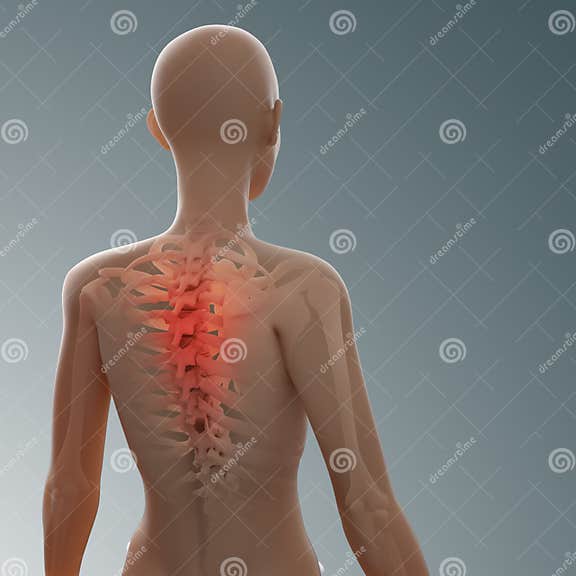 Back and spine injury stock illustration. Illustration of backache ...