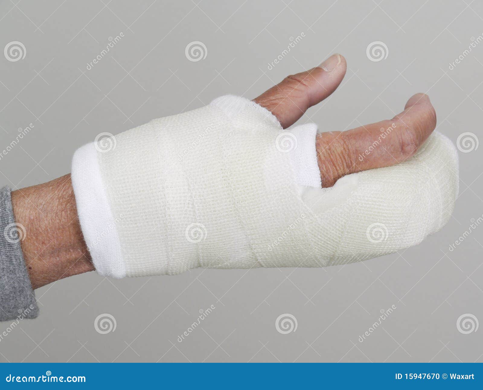 Back View of Hand in White Cast Stock Photo - Image of photograph ...