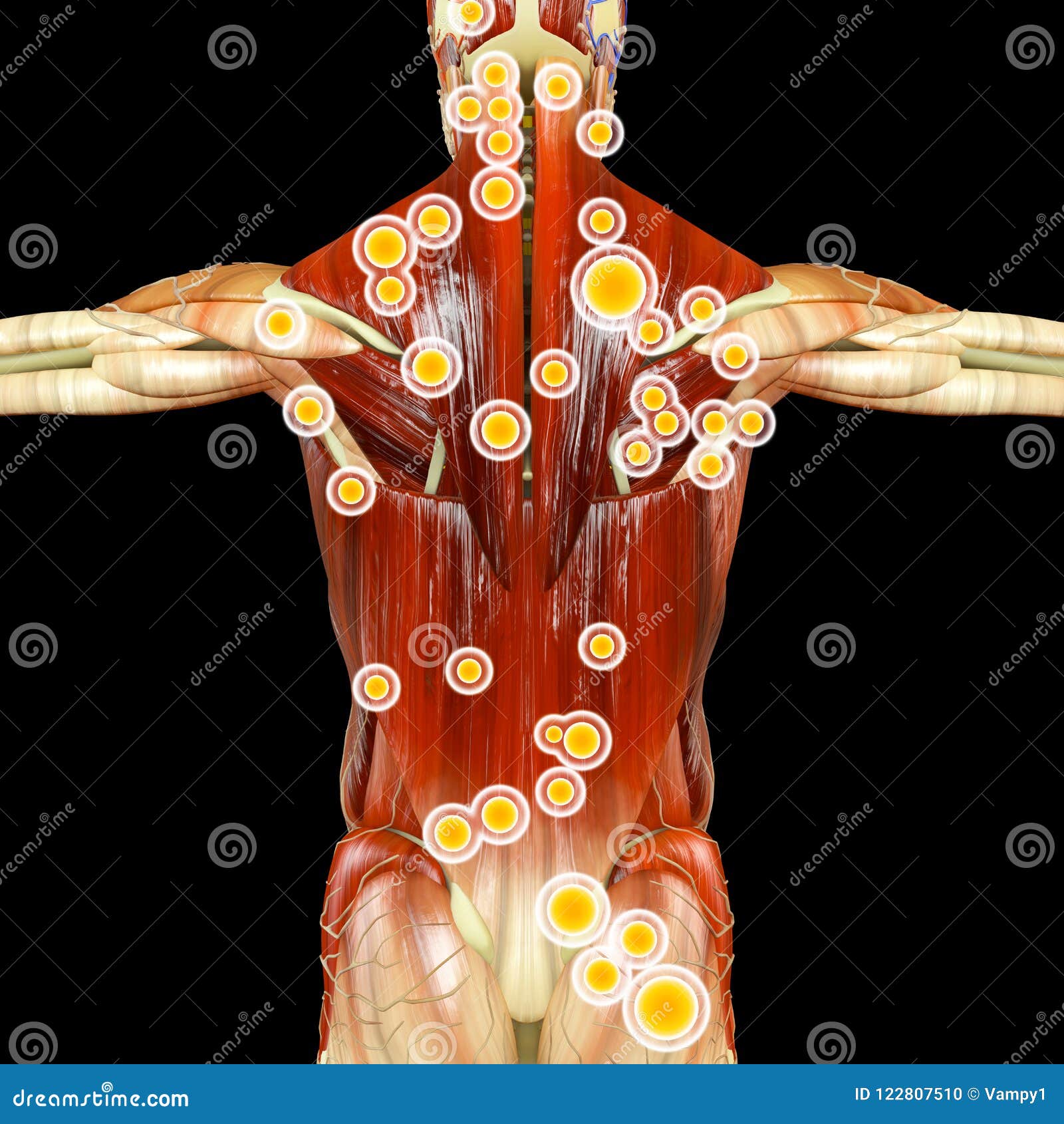 Back View of a Man and His Trigger Points. Anatomy Muscles. Myofascial ...