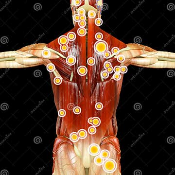 Back View of a Man and His Trigger Points. Anatomy Muscles. Myofascial ...