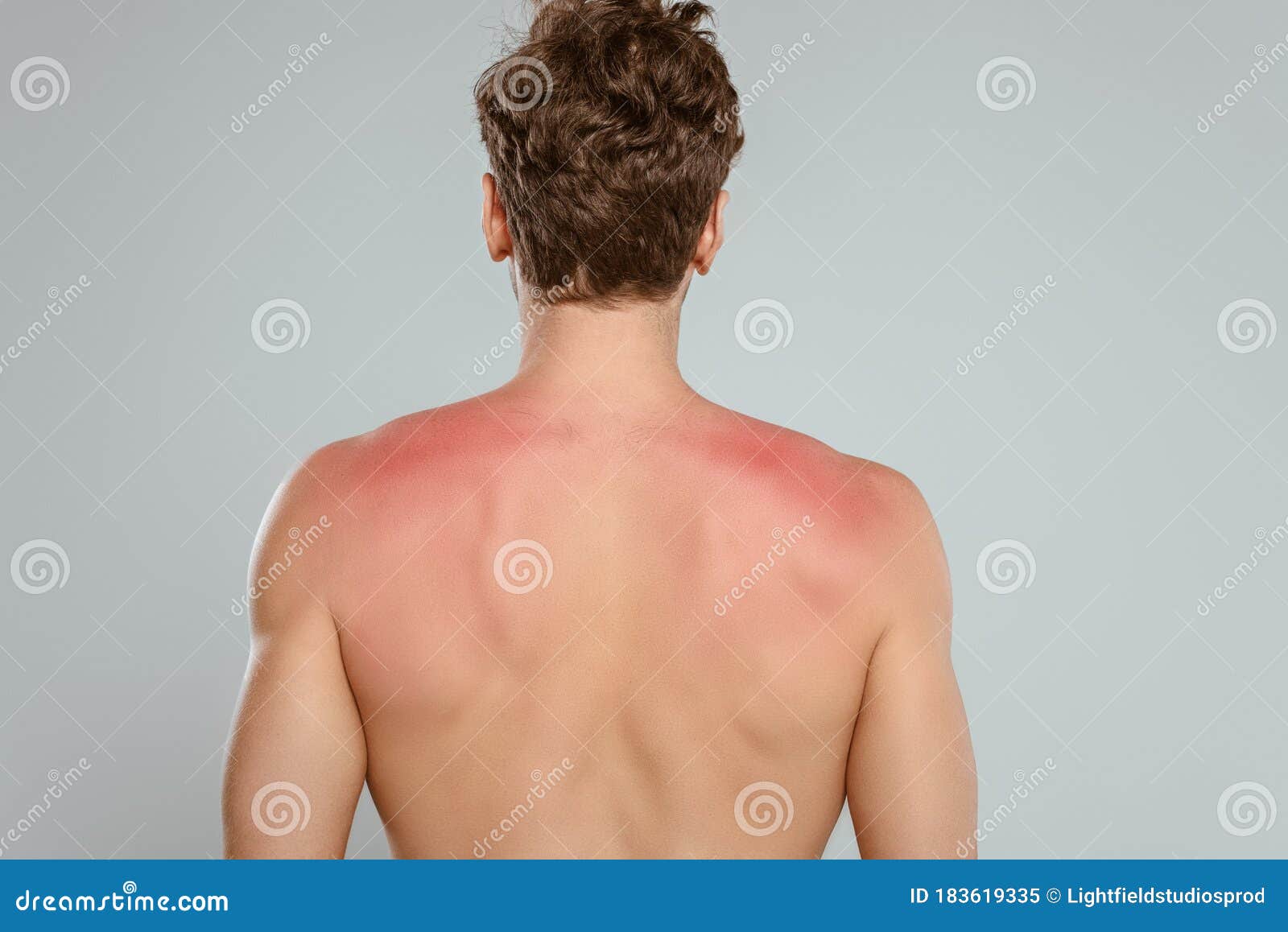 Back View of Man with Sunburn Stock Image - Image of dermatology ...