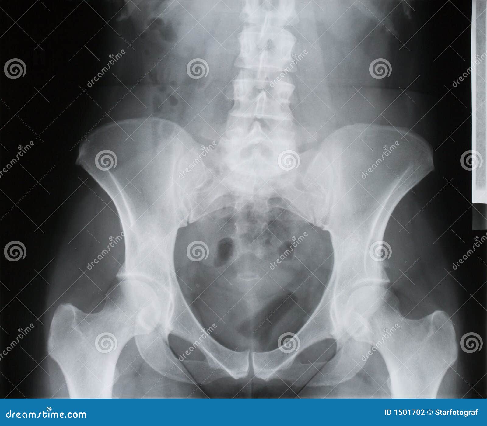 Backbone, Pelvis, Socket of Hip Joint, Thigh Bone X-ray, Osteoporosis ...