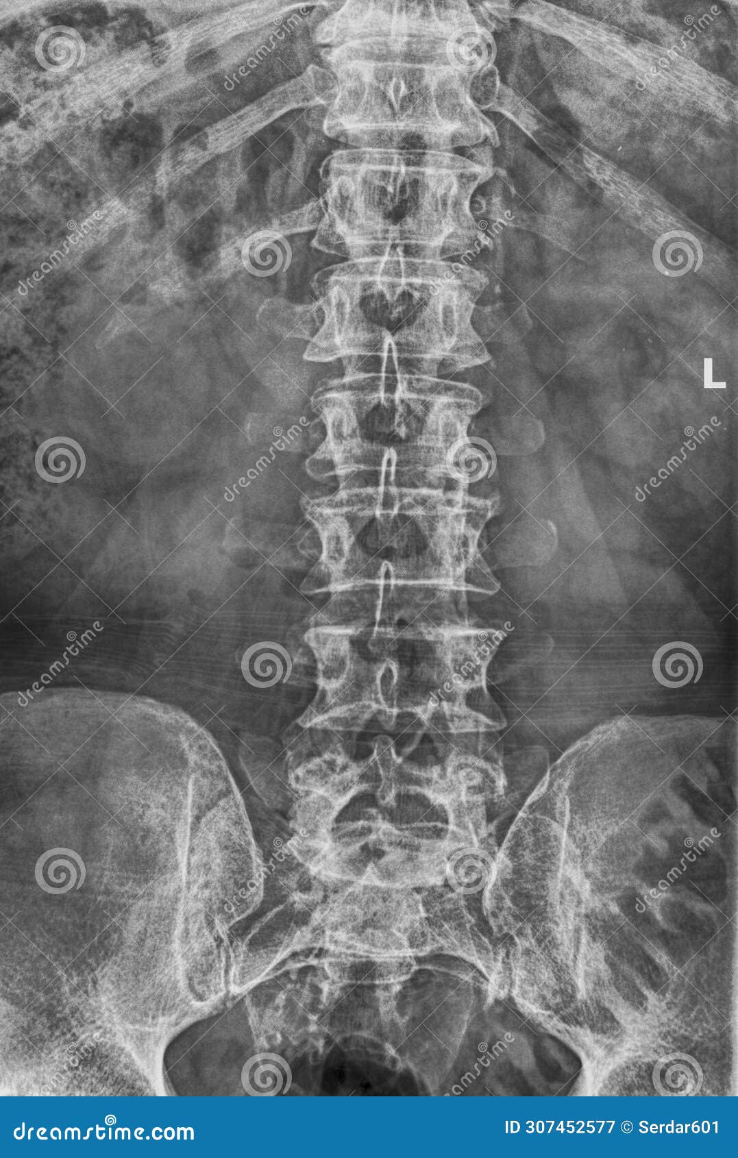 Backbone stock image. Image of pelvis, anatomy, bones - 307452577