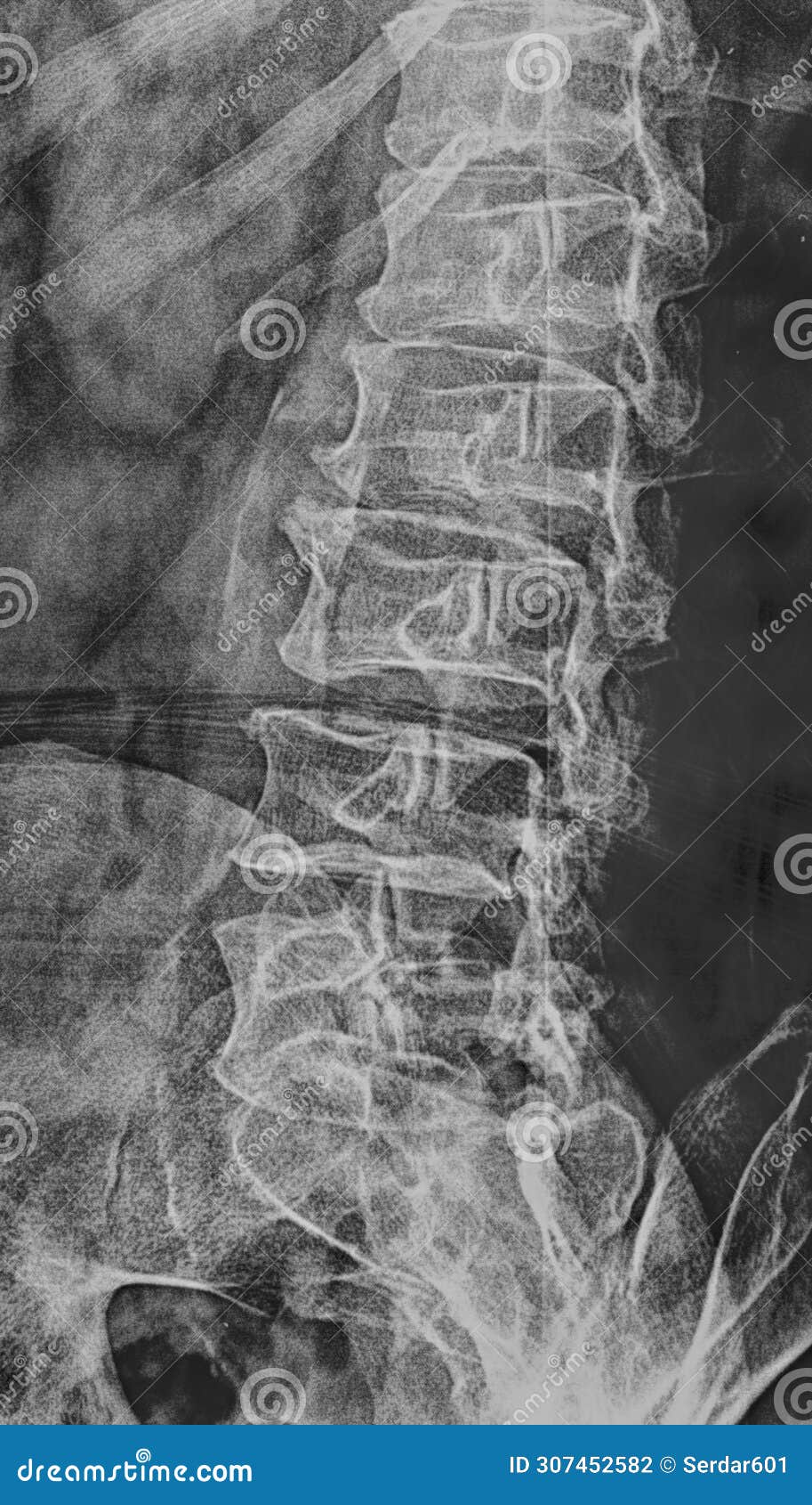 Backbone stock photo. Image of radiology, disease, anatomy - 307452582