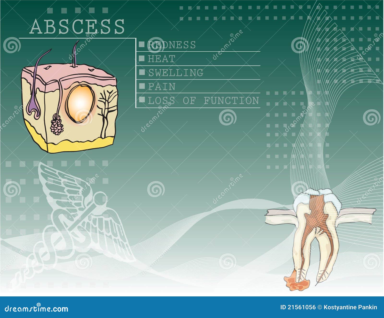 Abscess Cartoons, Illustrations & Vector Stock Images - 1328 Pictures ...