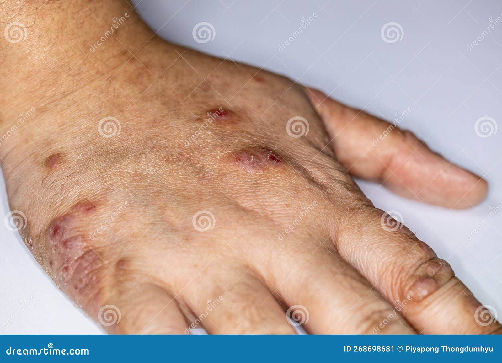 Background of Human Skin with Dust Mite Allergy. Stock Image - Image of ...
