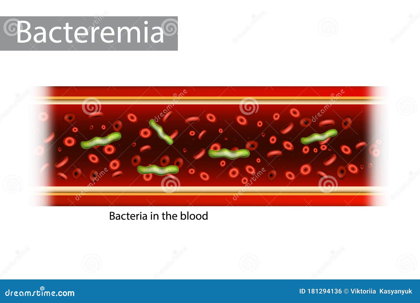 Bacteremia is the Presence of Bacteria in the Blood. Stock Vector ...