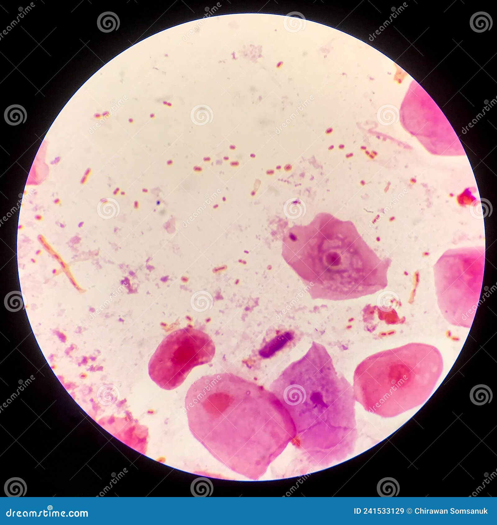 Bacteria Cell Gram Neagative Bacilli with Capsule.Sample Sputum in Gram ...
