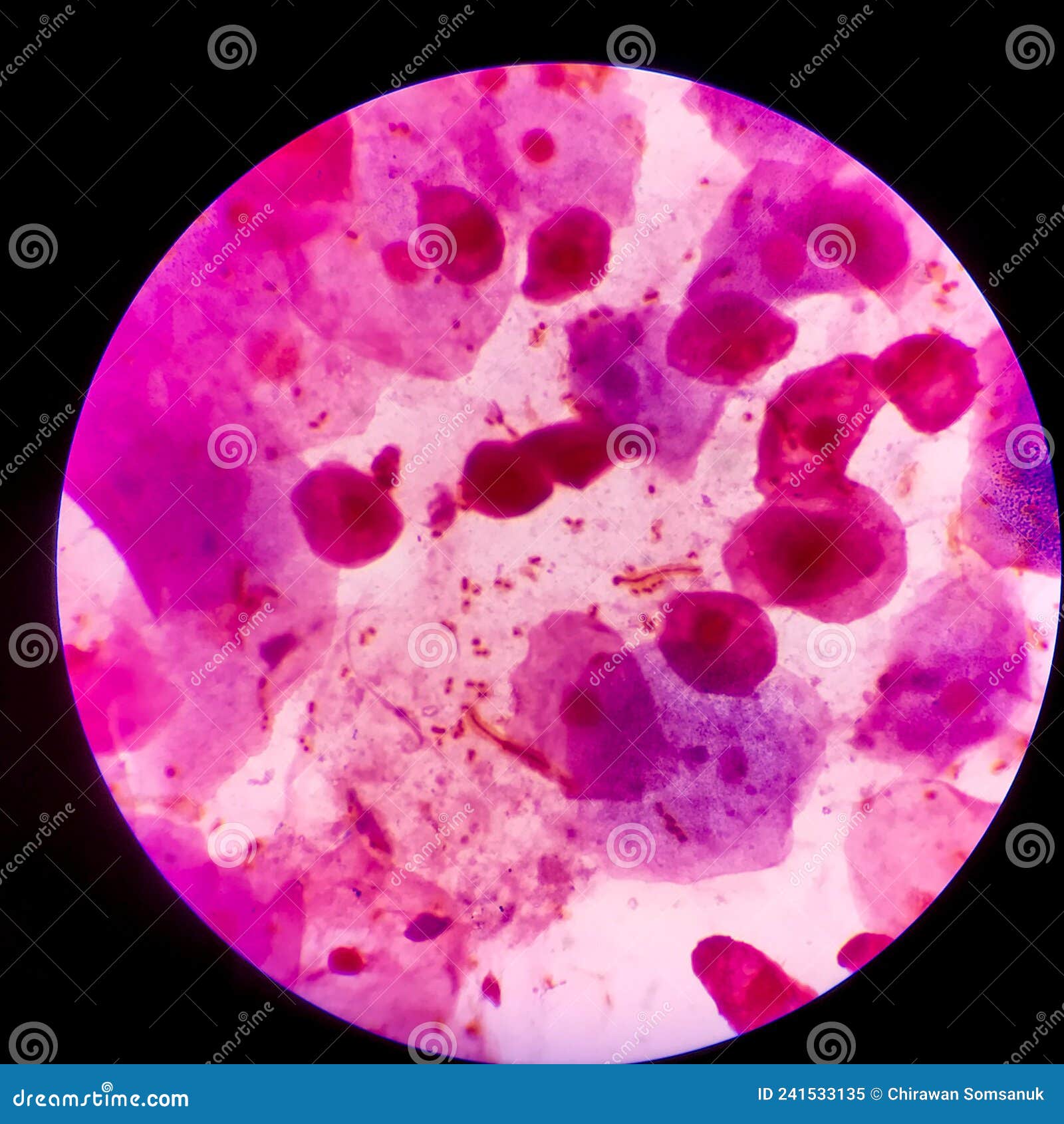 Bacteria Cell Gram Neagative Bacilli with Capsule.Sample Sputum in Gram ...