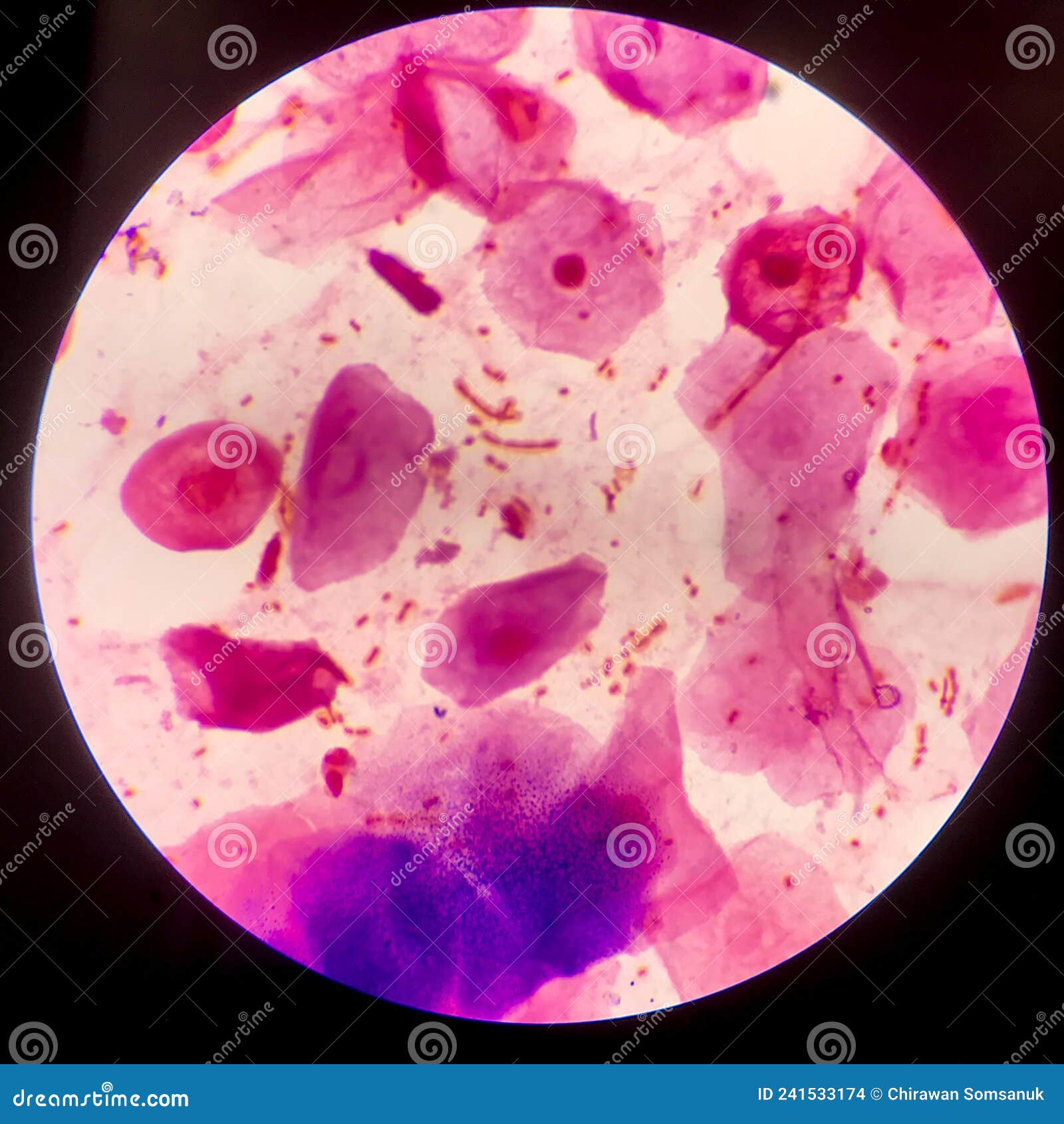Bacteria Cell Gram Neagative Bacilli with Capsule.Sample Sputum in Gram ...