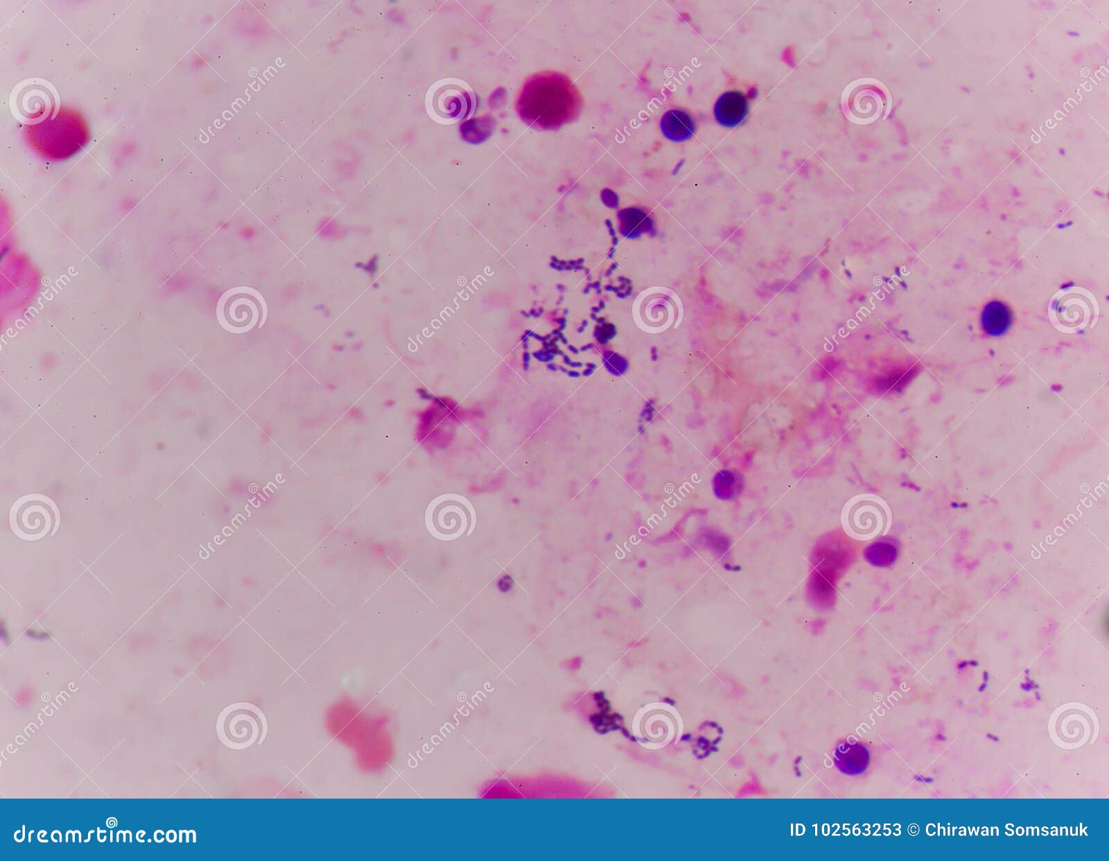Trichomonas Vaginalis Gram Stain