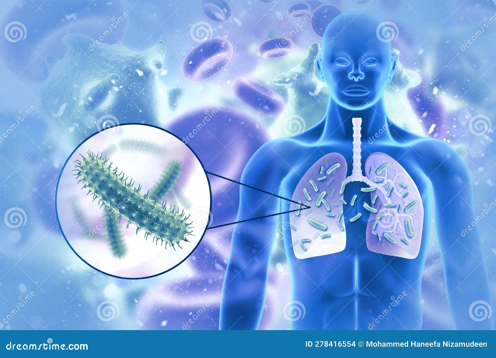 Bacteria Infected Human Lungs. Chest Infection Stock Illustration ...