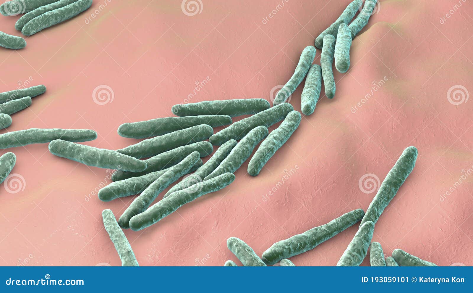 Mycobacterium Tuberculosis Infection (Pulmonary Tuberculosis) Stock ...