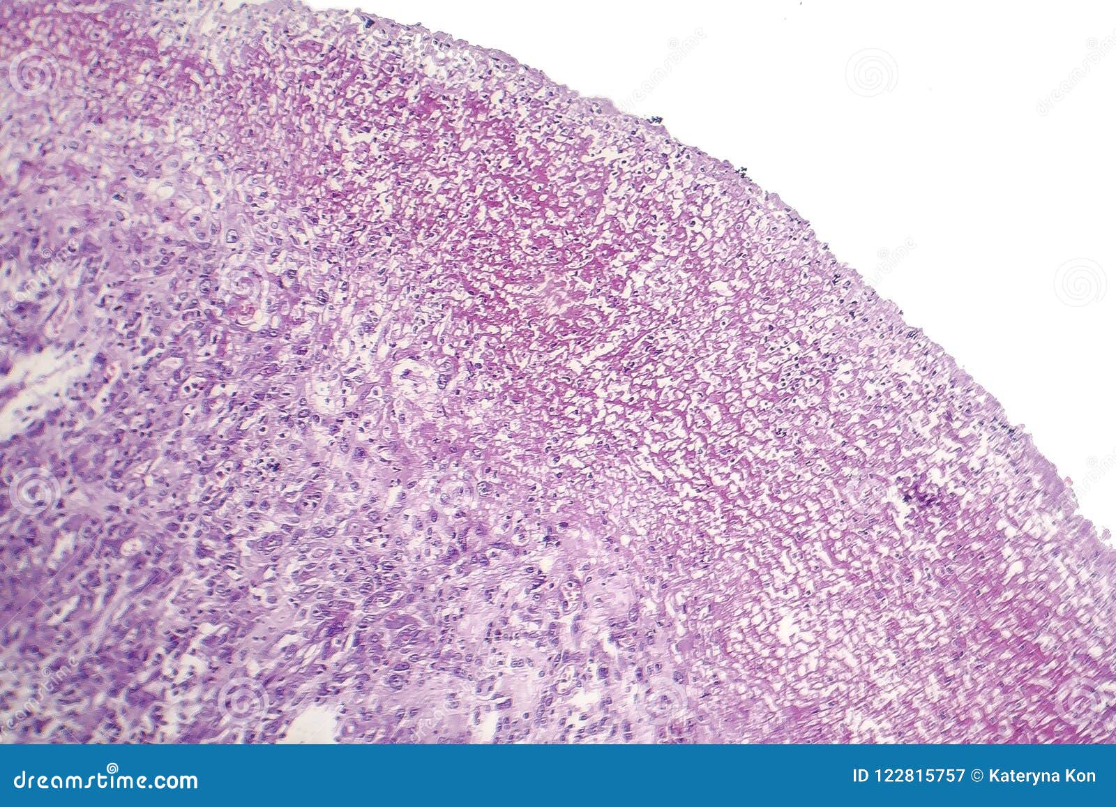 Bacterial Dysentery, Light Micrograph Stock Image - Image of ...