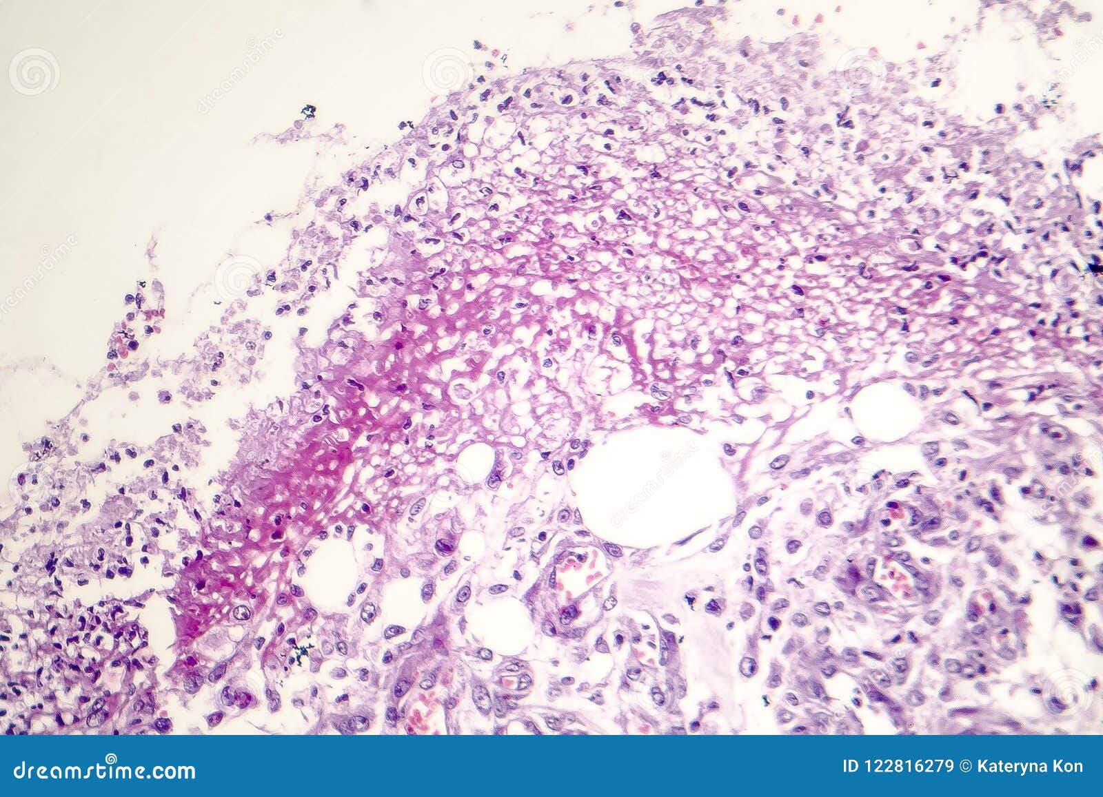 Bacterial Dysentery, Light Micrograph Stock Image - Image of ...