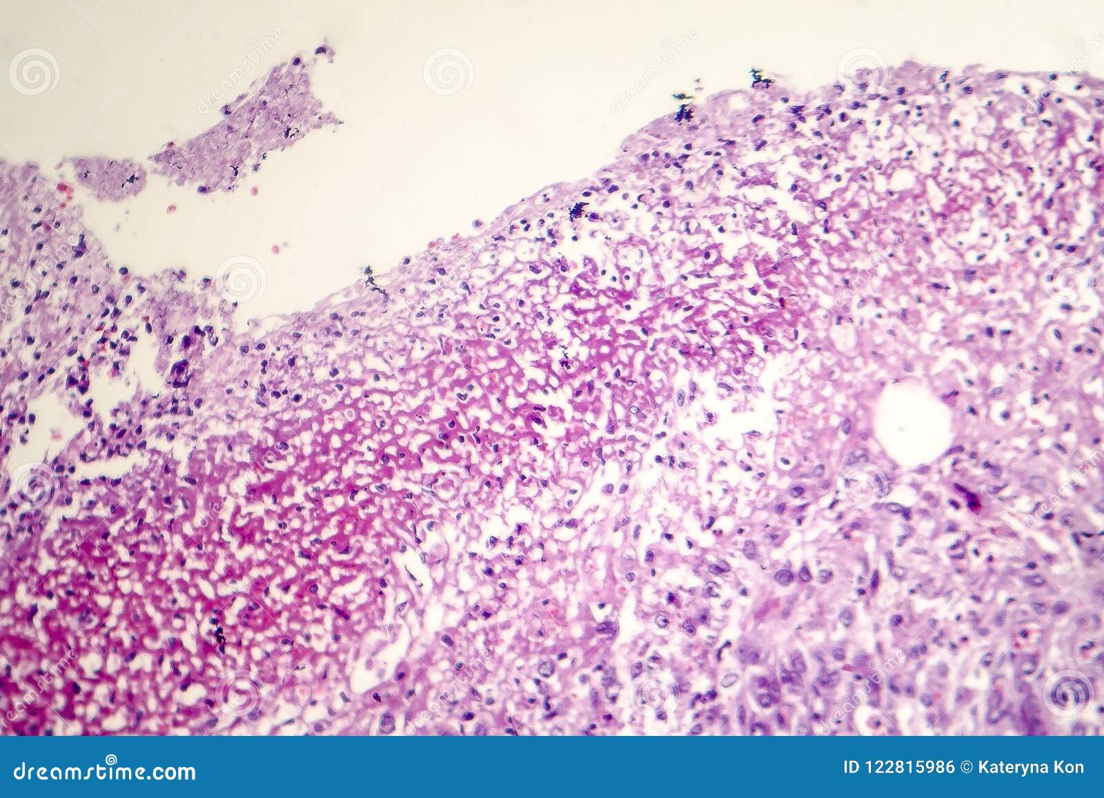 Bacterial Dysentery, Light Micrograph Stock Photo - Image of histology ...