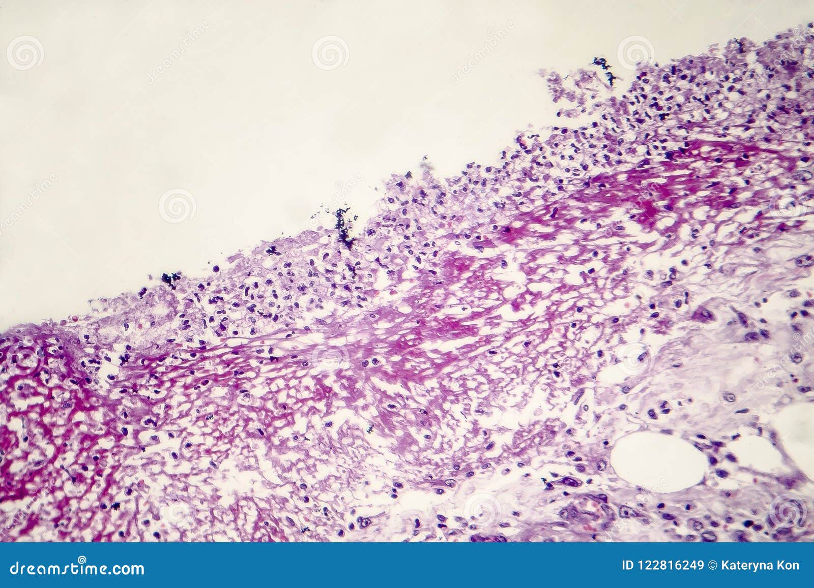 Bacterial Dysentery, Light Micrograph Stock Image - Image of epithelium ...