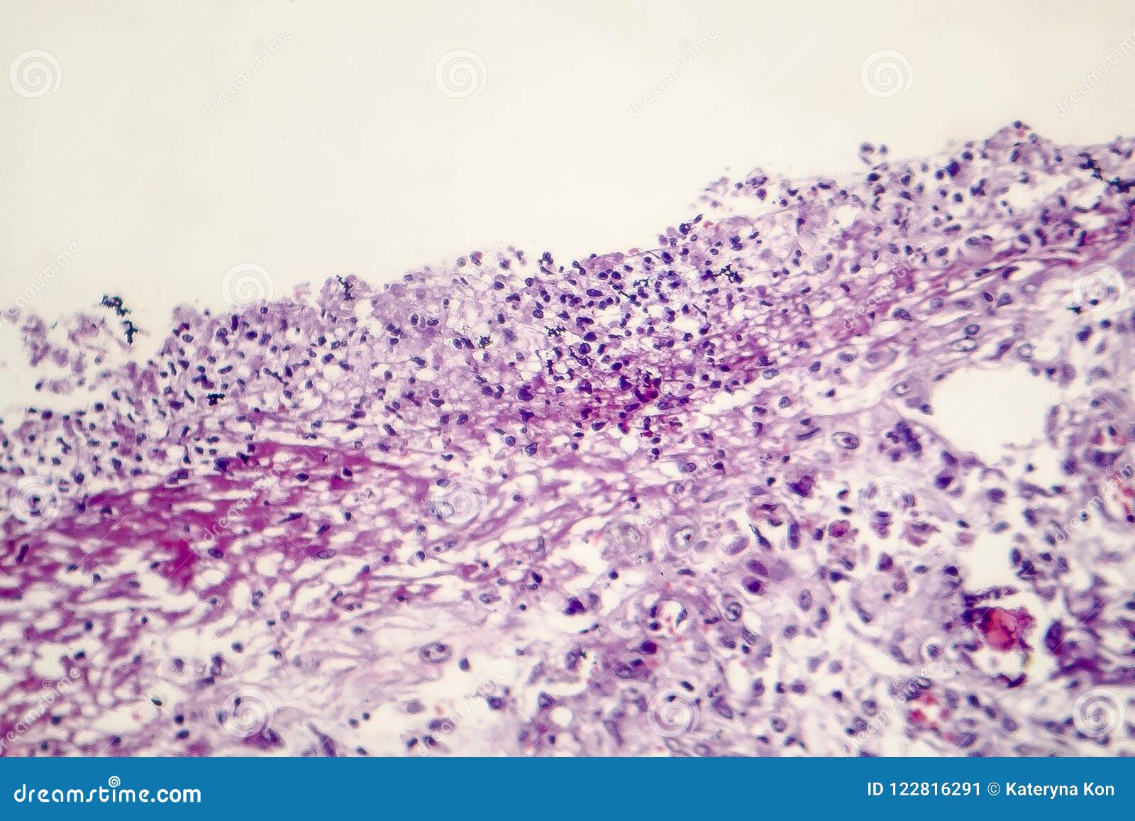Bacterial Dysentery, Light Micrograph Stock Image - Image of micrograph ...