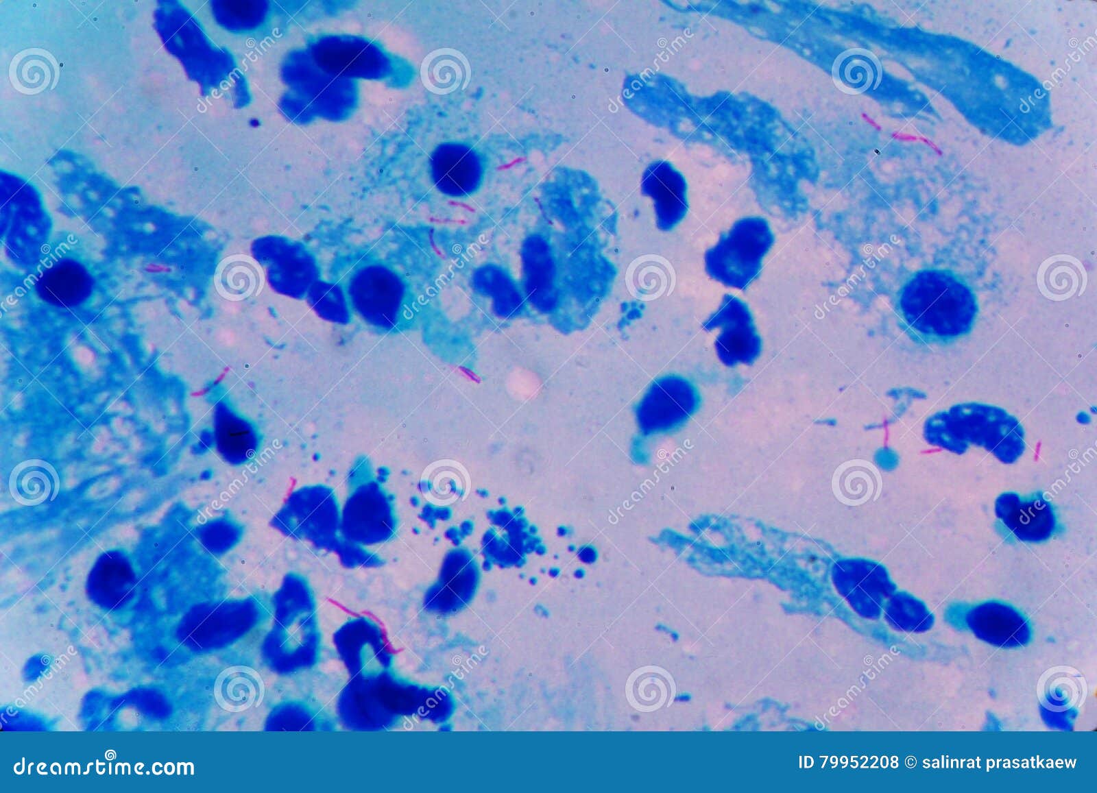 The Bacterium Mycobacterium Tuberculosis Undermicroscope 100x /AFB ...