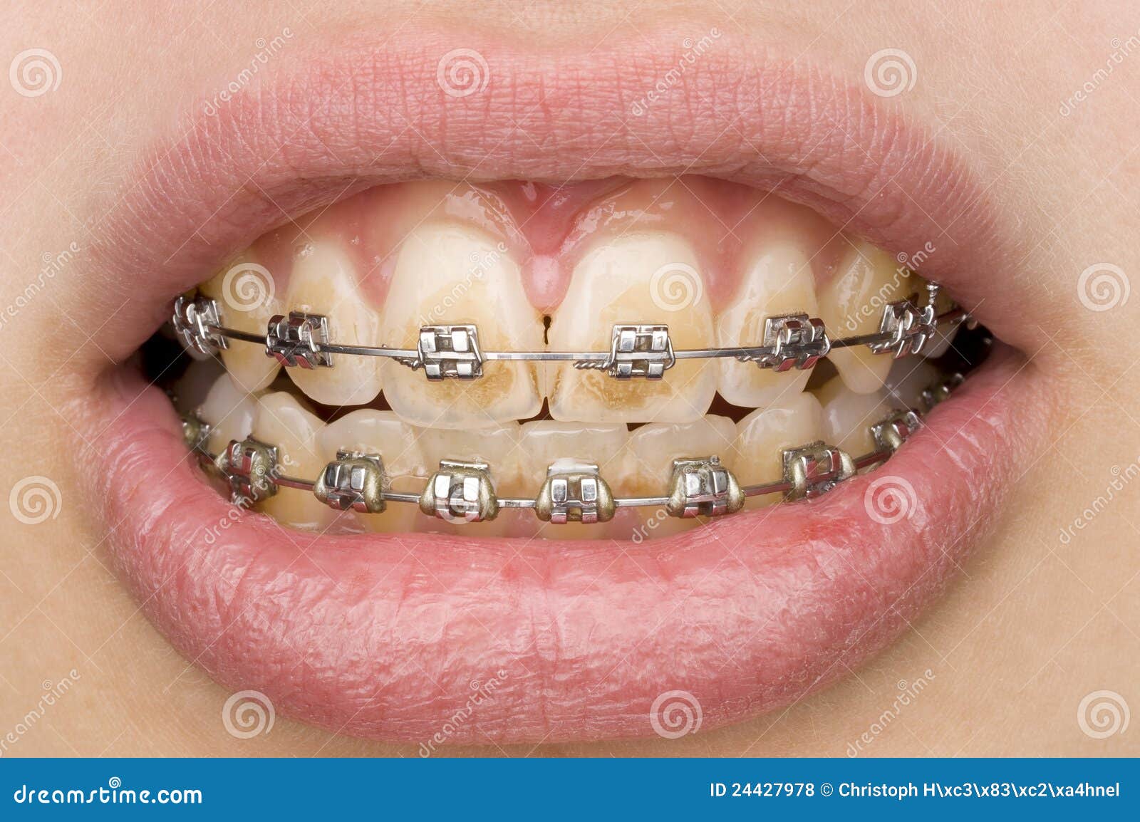 Bad oral hygiene stock photo. Image of cavity, cleaning - 24427978