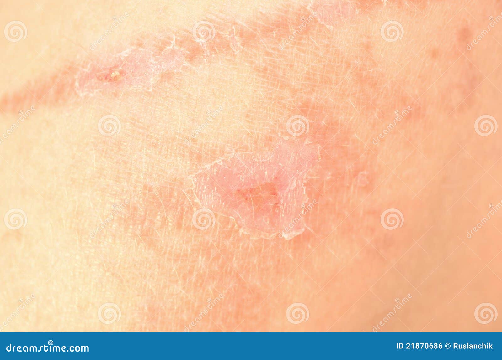 Bad skin stock photo. Image of bacteria, contagiousness - 21870686