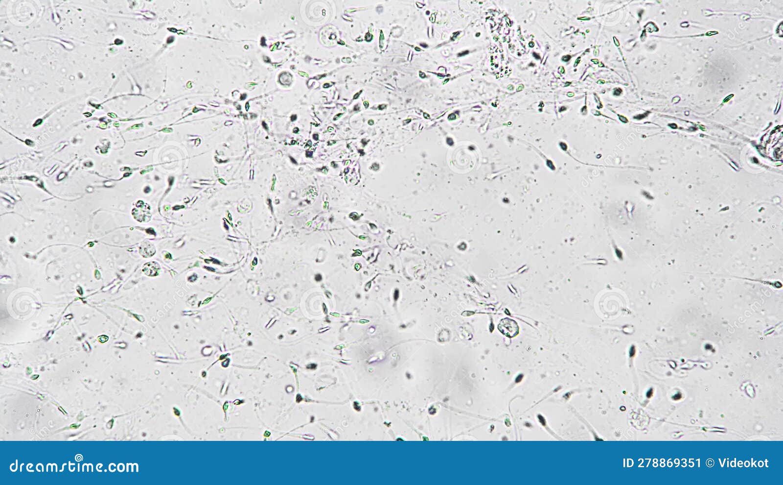 Bad Spermogram of Male Semen Under Microscope Magnified 400 Times on ...