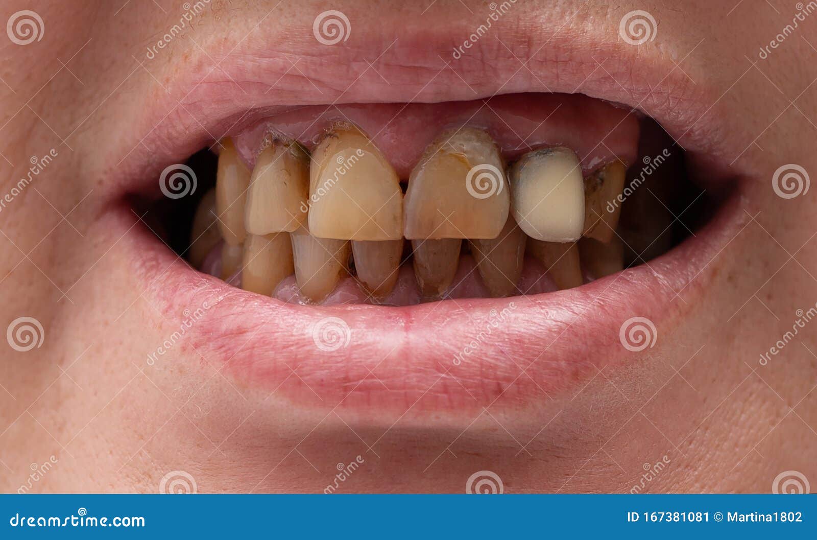 Bad spoiled teeth stock image. Image of dental, patient - 167381081