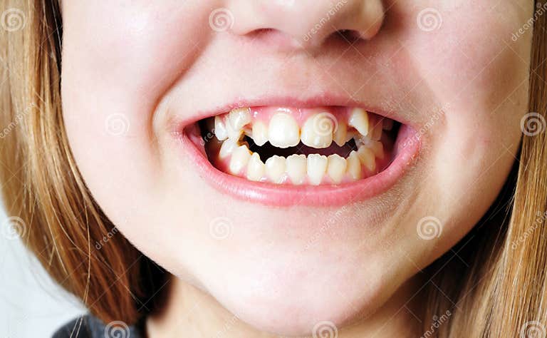 Bad teeth stock photo. Image of clinical, closeup, examine - 13398592